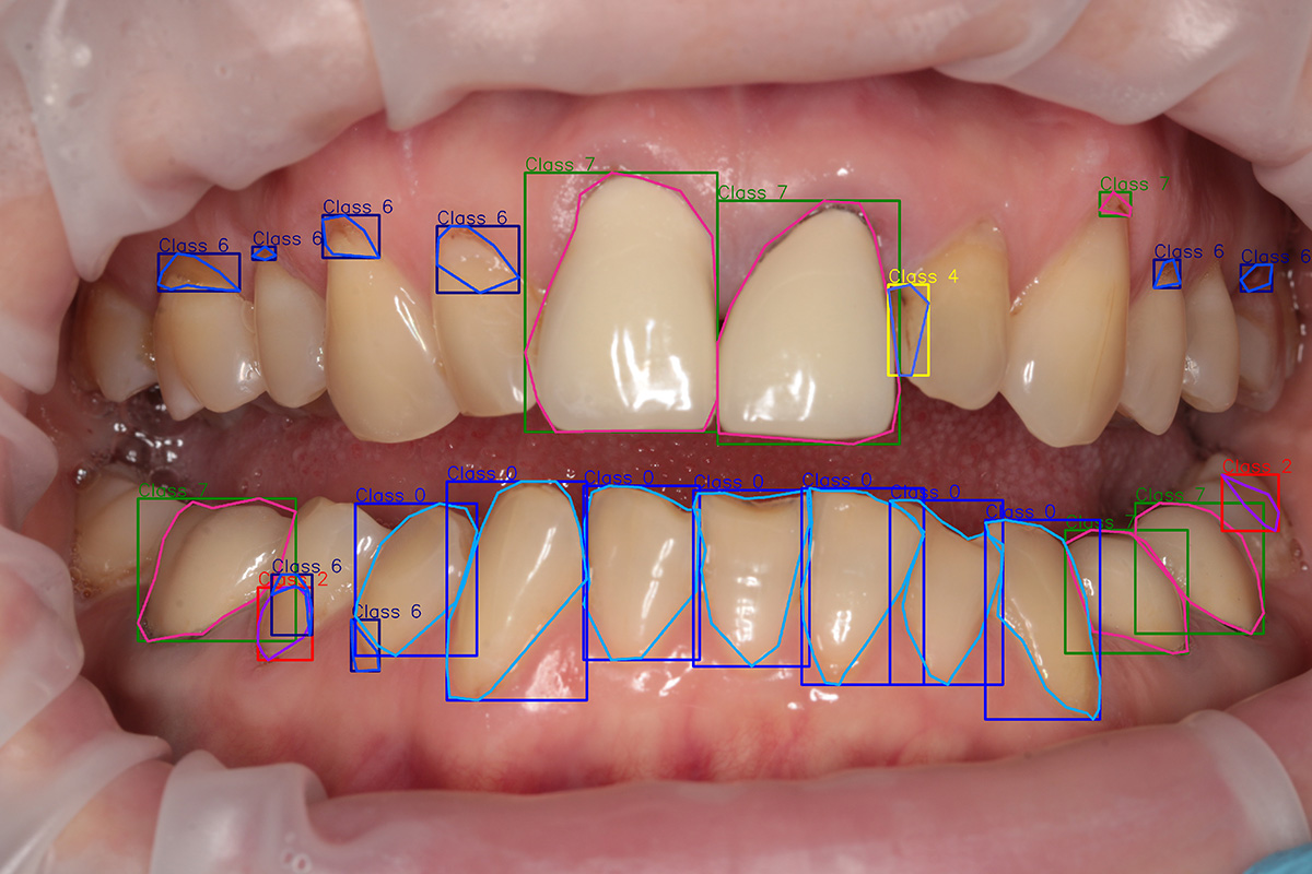 AlphaDent: Teeth marking | Kaggle